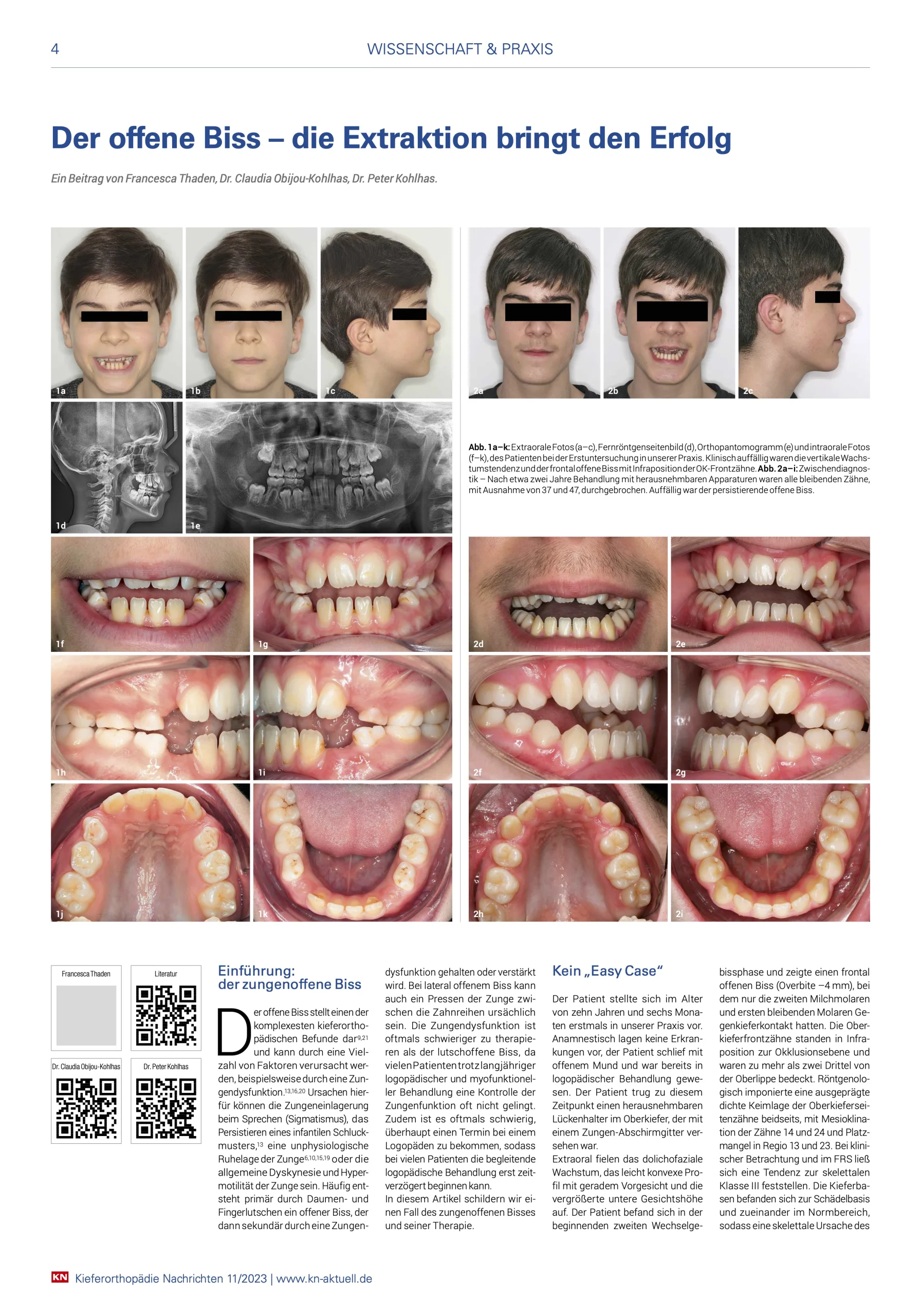 Der offene Biss – die Extraktion bringt den Erfolg ...